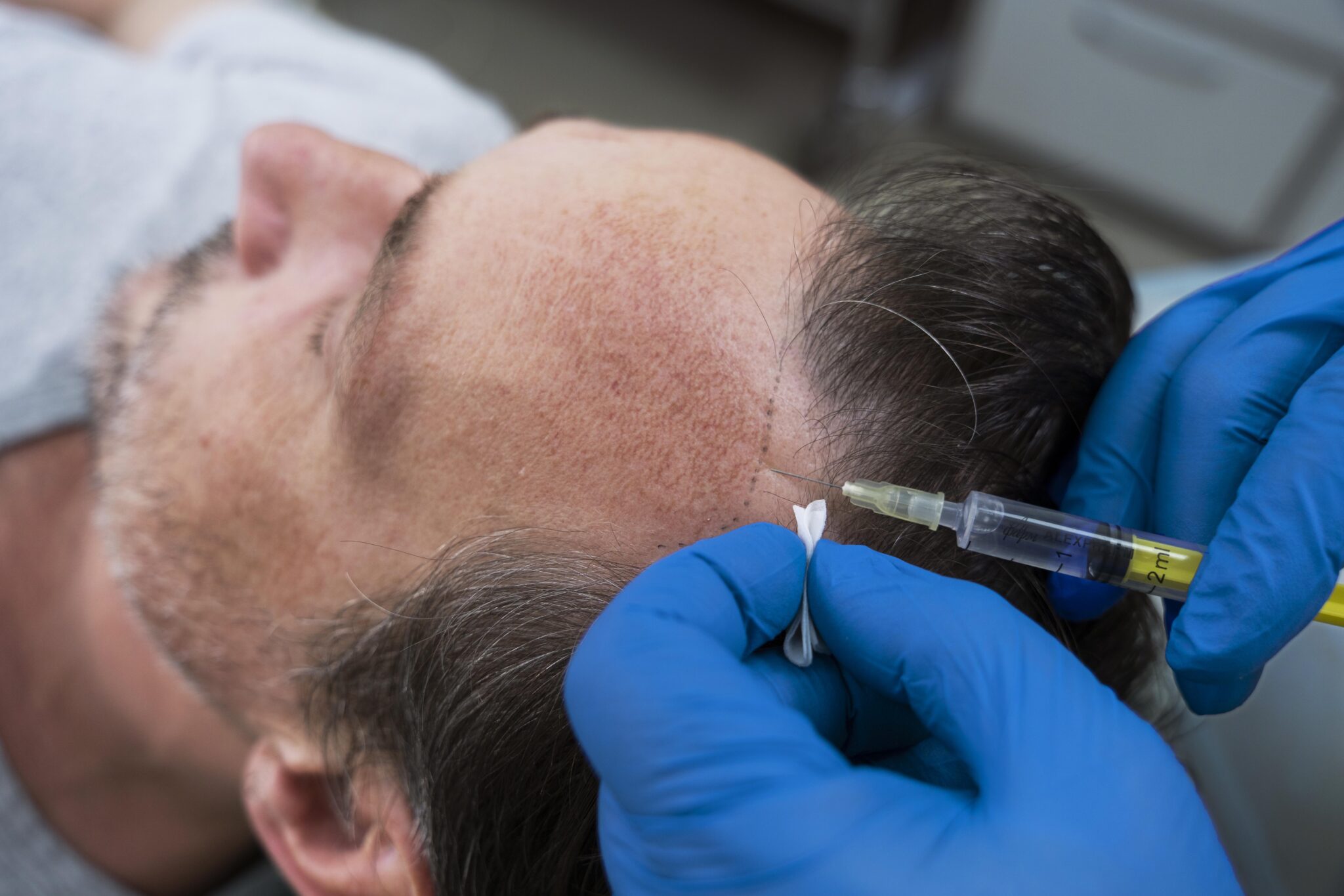 Hair Regrowth - Skinfinity Luxe Clinic - Best Skin Clinic in Bangalore
